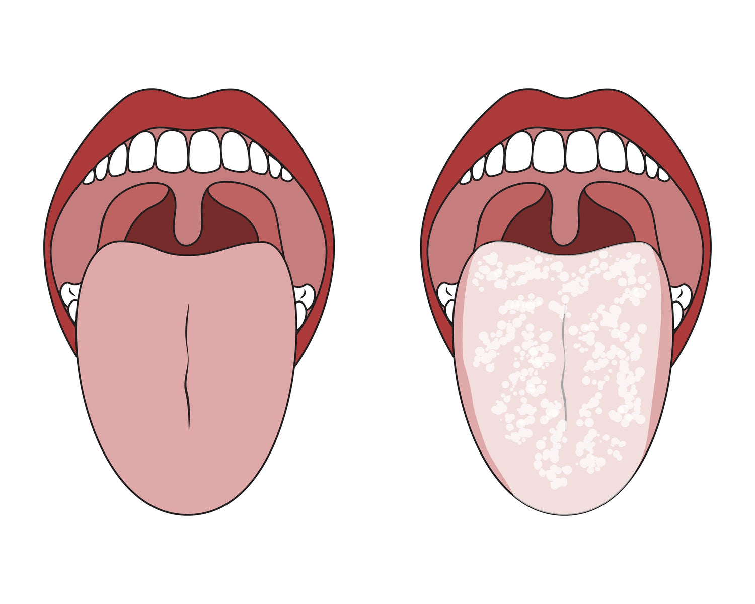 Oral Thrush and Candida: The Gut-Oral Connection Explained + How to Br ...